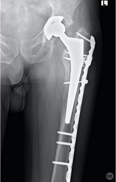 Periprosthetic fracture