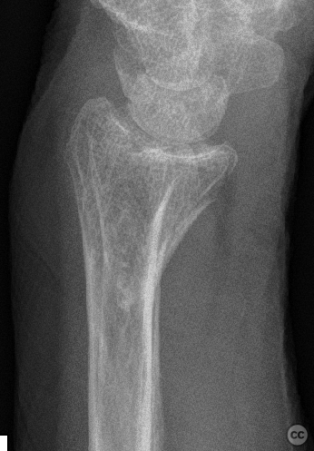 Volar Barton's volar rim fracture distal radius