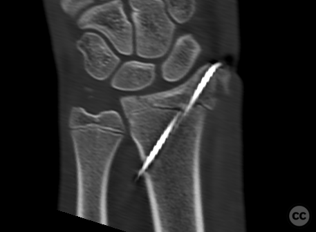 Malunion Salter III distal radius fracture dislocation
