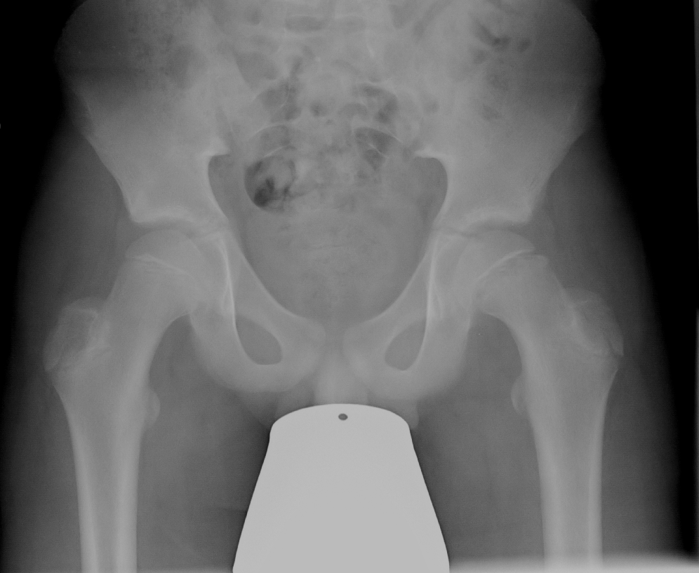 SCFE - Grade I - closed reduction and MIS osteosynthesis