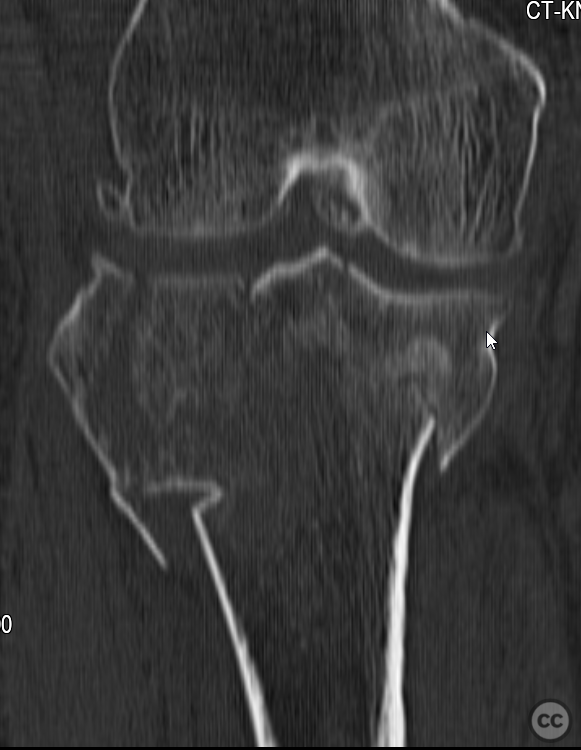 Failure of fixation and secondary collapse of a Schatzker V-VI tibial ...
