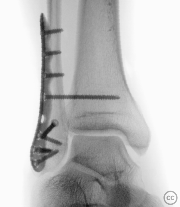 SER ankle injury with occult PITFL + deltoid instability