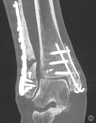 Failed pronation - external rotation (PER) ankle fracture dislocation