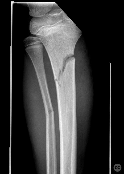 13yo proximal tibial diametaphyseal transition zone fracture