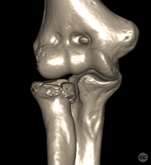 Mason II Radial Head Fracture