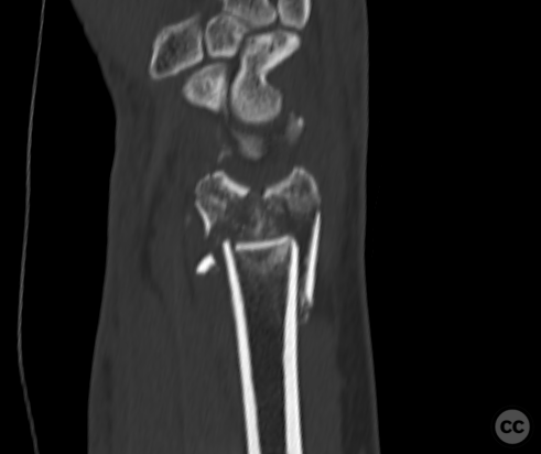 High energy C3 distal radius with metaphyseal defect