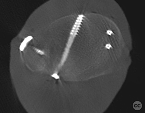 Pronation Abduction (PAb) ankle fracture with Mason 2A lateral plafond ...
