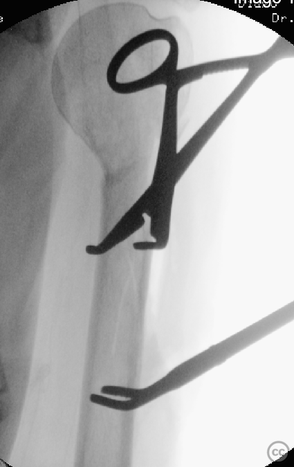 Anterolateral Helix plate - segmental proximal humerus fracture