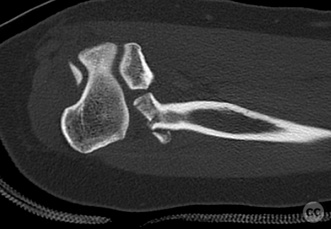 Mason III radial head fracture - Boyd's approach