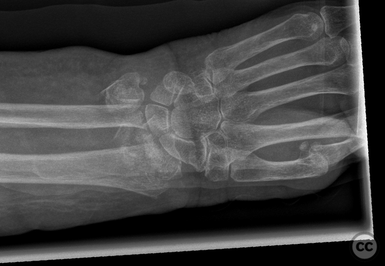 Concomitant distal radius and ulna geriatric fragility fracture