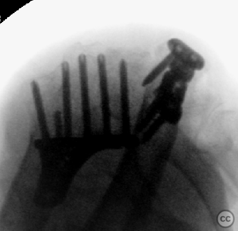 Radiocarpal distraction reduction technique for distal radius fracture