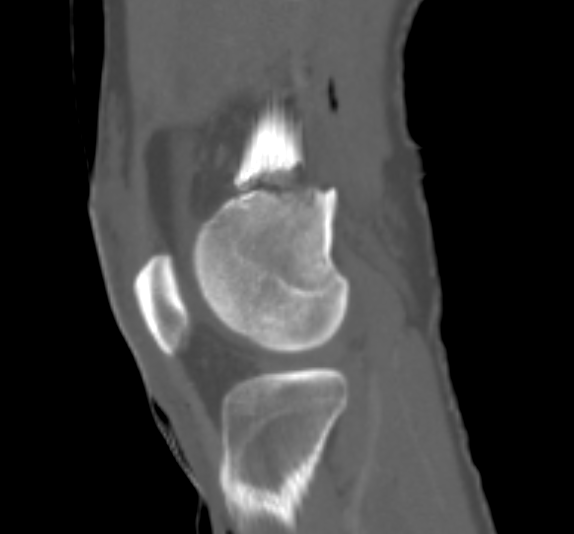 Segmental Femur with intercondylar separation