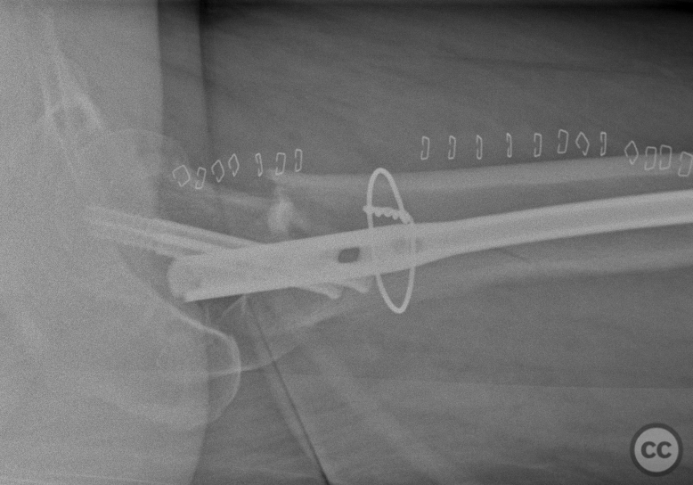 Multifragment intertrochanteric femur fracture with subtrochanteric ...