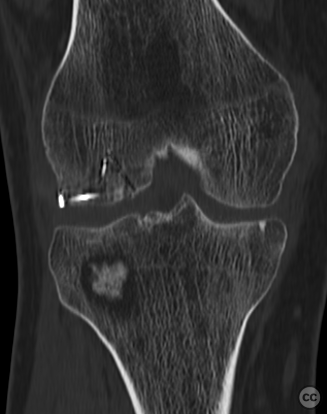 Destructive osteochondral fracture of the lateral femoral condyle ...