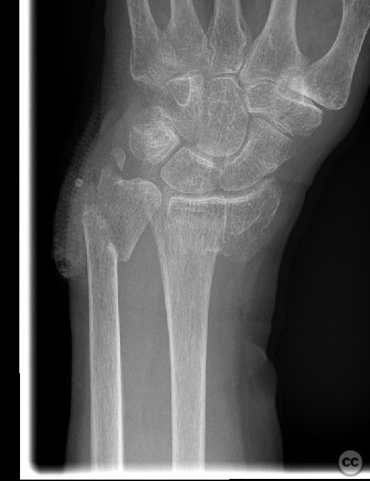 Radiocarpal distraction reduction technique for distal radius fracture