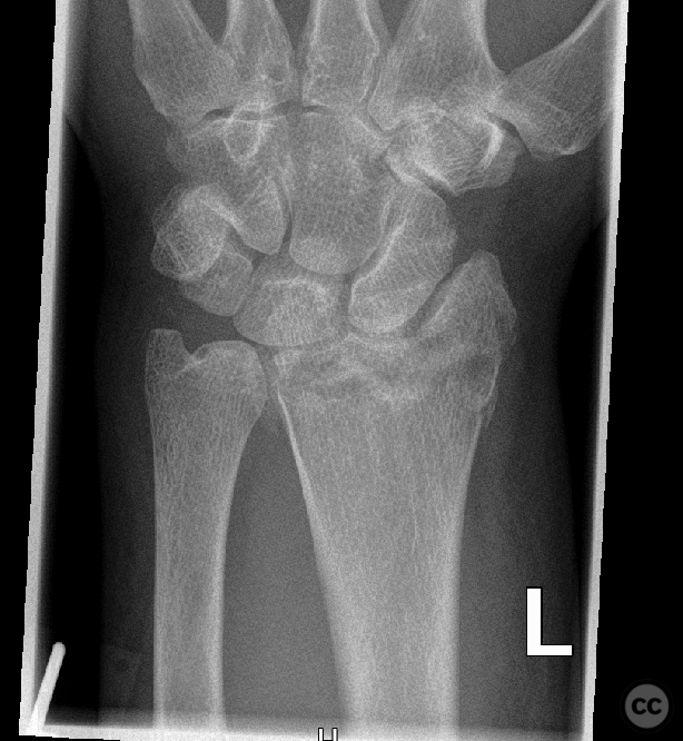 270deg plating of a comminuted distal radius fracture