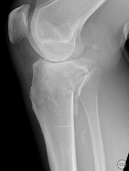 Posterolateral approach to the tibial plateau with femoral epicondylar ...
