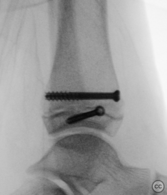 Percutaneous Cannulated Screw Fixation of a Triplanar Distal Tibial ...
