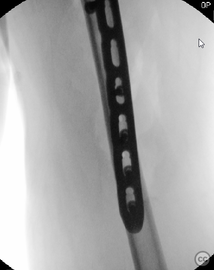 Anterolateral Helix plate - segmental proximal humerus fracture