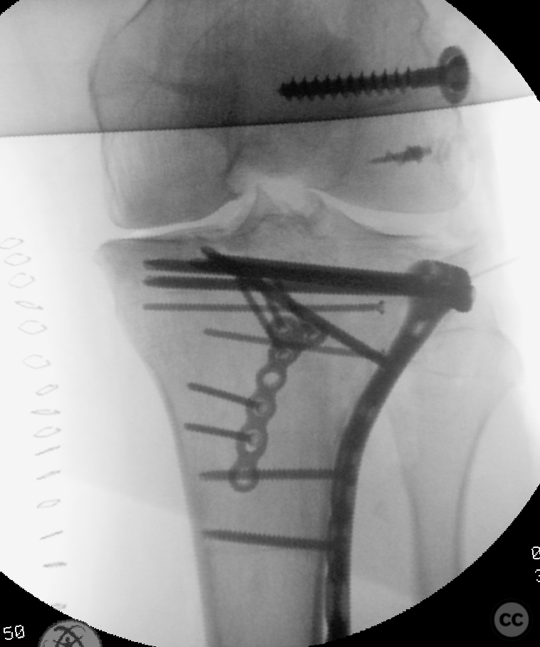Posterolateral approach to the tibial plateau with femoral epicondylar ...