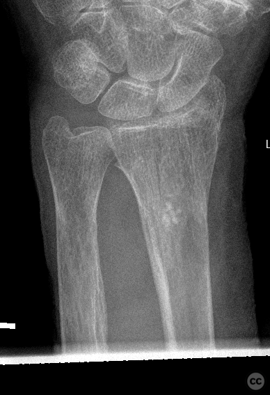 Volar Barton's volar rim fracture distal radius