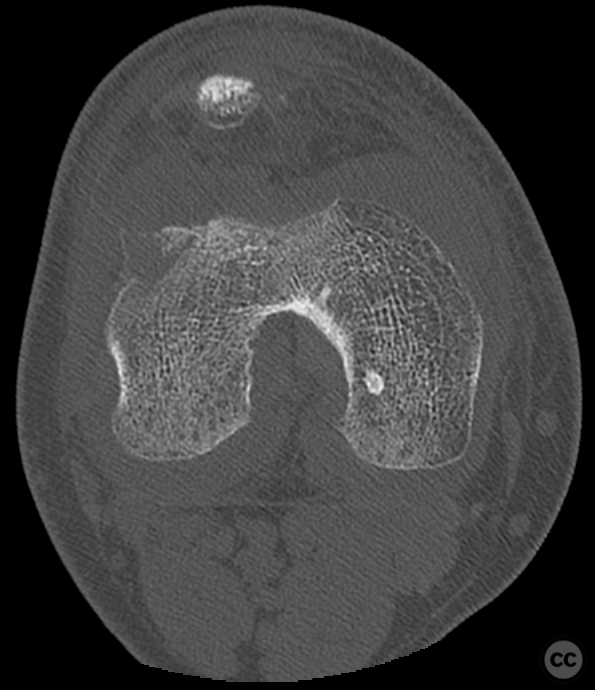 Destructive osteochondral fracture of the lateral femoral condyle ...