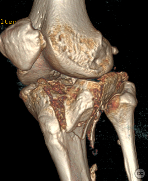 Posterolateral approach to the tibial plateau with femoral epicondylar ...