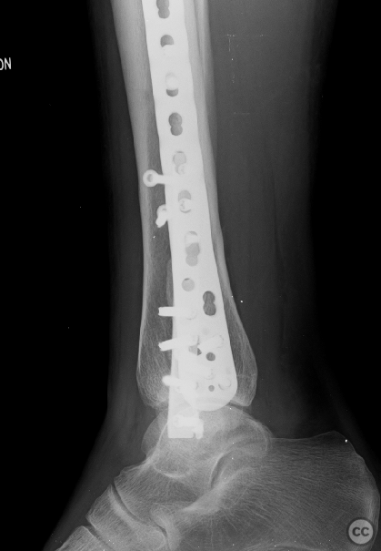 Combined distal 1/3 tibia fracture with SAD bimalleolar ankle fracture
