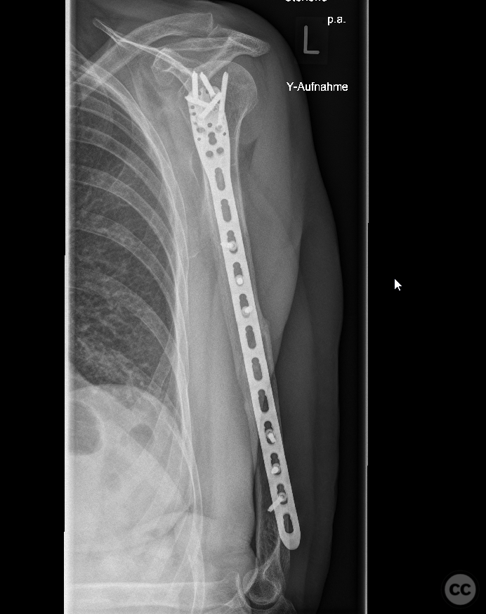 Aggregate lateral approach to a long segmental spiral humerus fracture