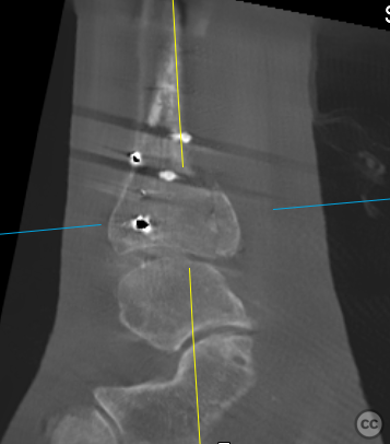 Failed pronation - external rotation (PER) ankle fracture dislocation