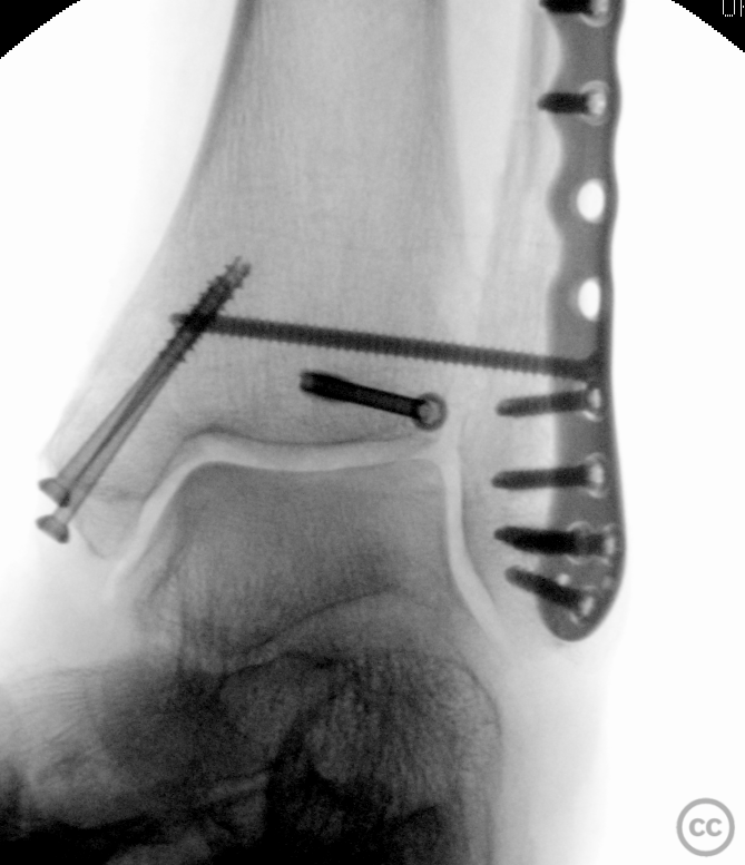Pronation Abduction (PAb) ankle fracture with Mason 2A lateral plafond ...
