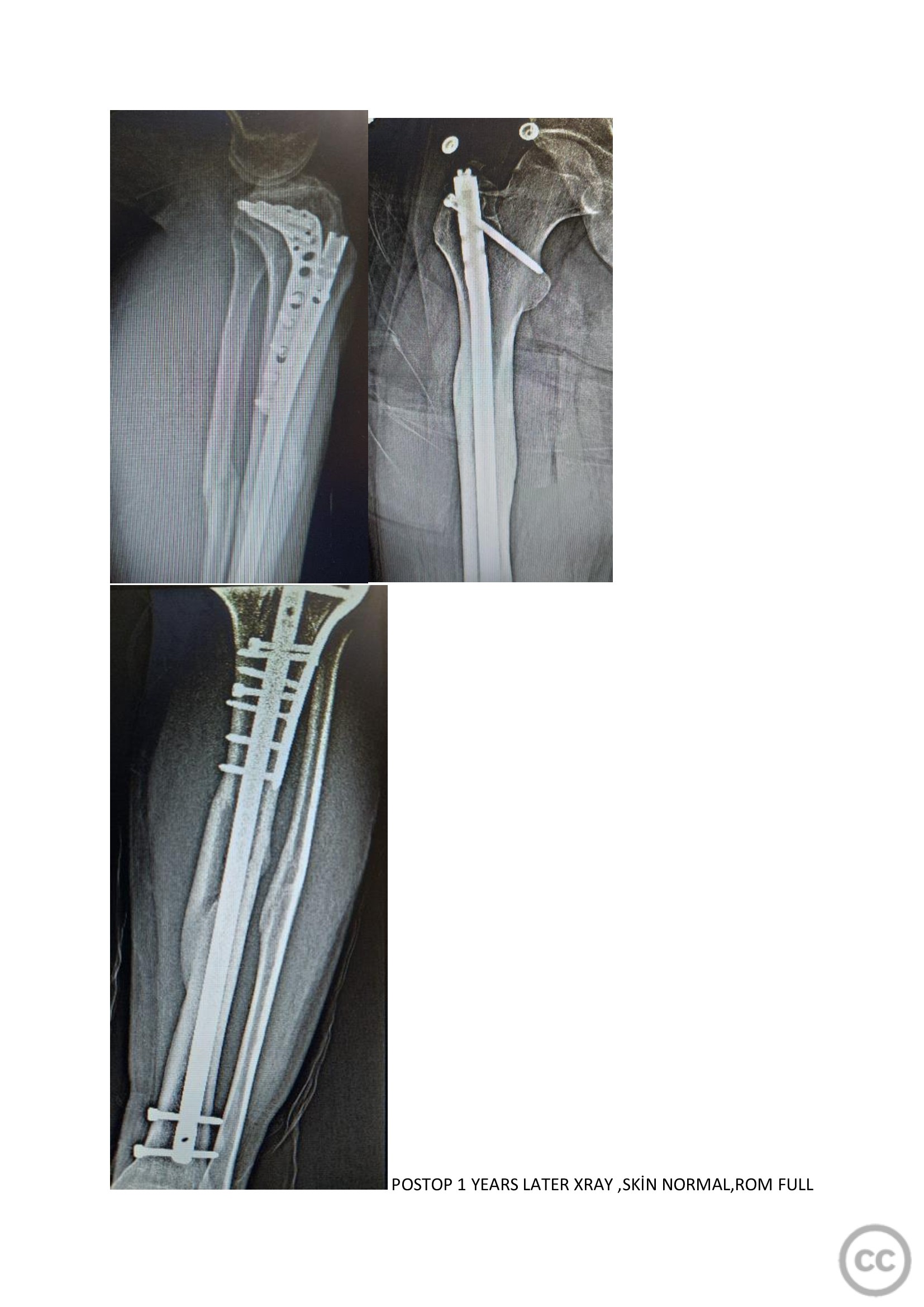 Polytrauma - ipsilateral tibial plateau and shaft, femoral shaft ...