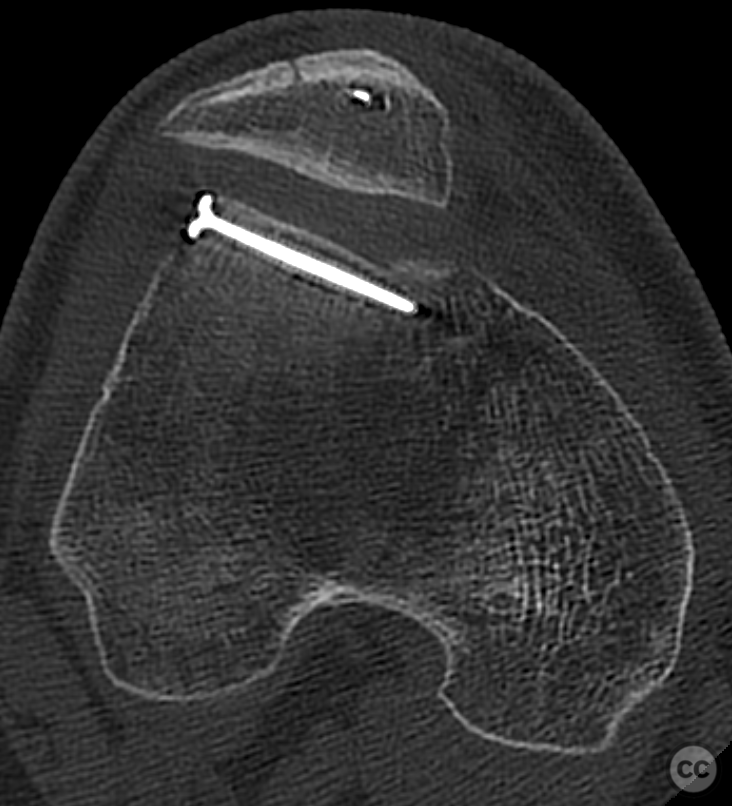 Destructive osteochondral fracture of the lateral femoral condyle ...