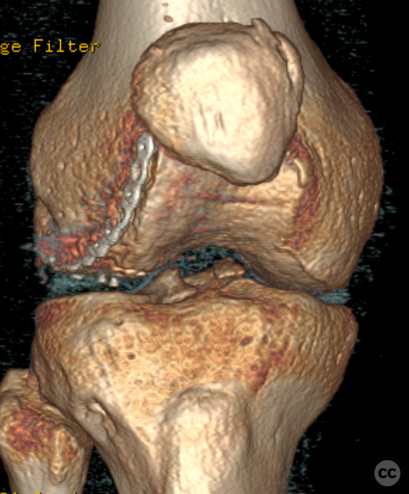 Destructive osteochondral fracture of the lateral femoral condyle ...