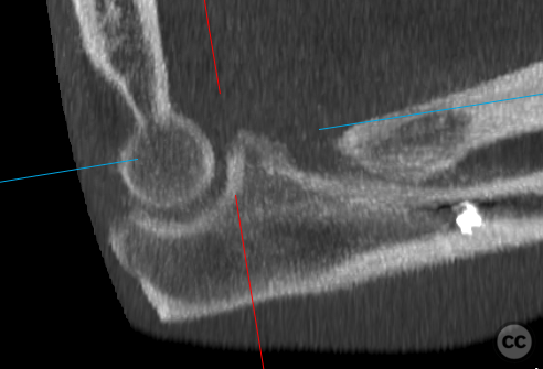 Open posterolateral elbow dislocation with displaced radial neck fracture