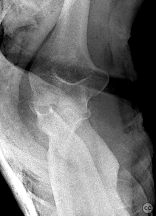 PMRI following elbow dislocation with pMCL insufficiency