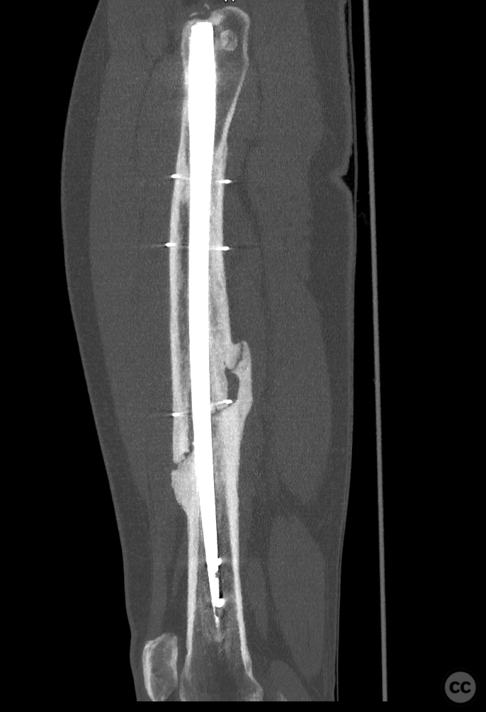 Closed segmental comminuted femoral fracture