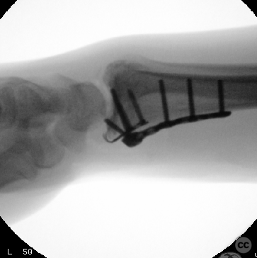 Malunion Salter III distal radius fracture dislocation