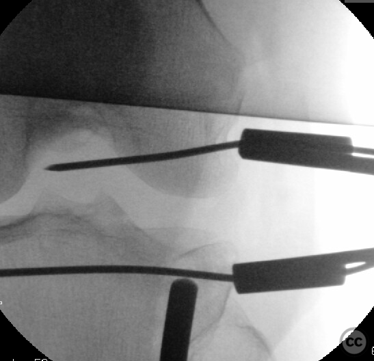 Jail-screw fixation posterolateral plateau impression fracture