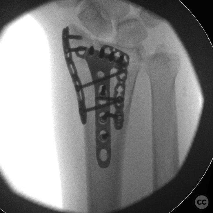 270deg plating of a comminuted distal radius fracture