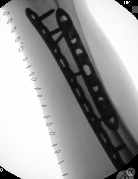 Henry's approach to a segmental radial shaft fracture