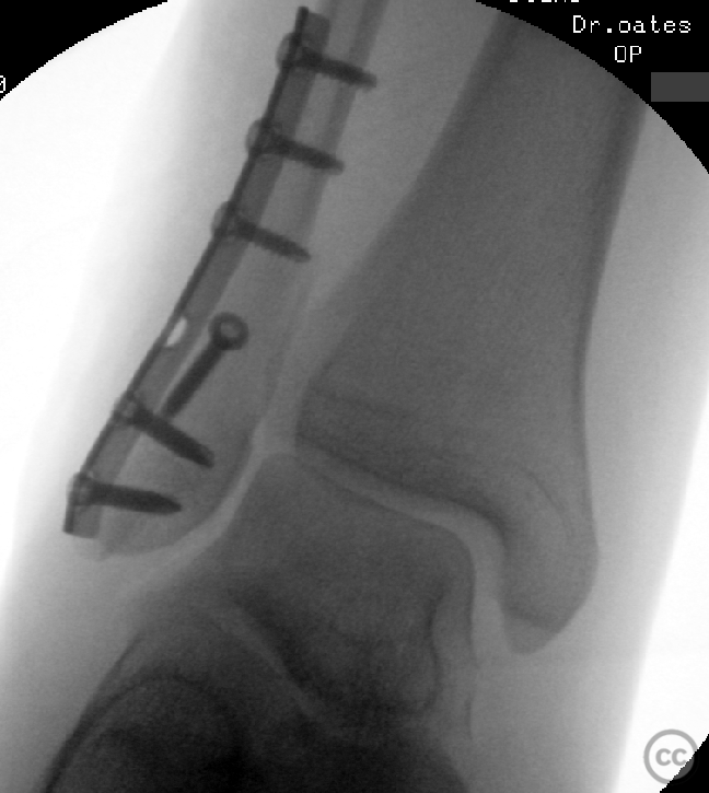 Simple SER Weber B fibula fracture