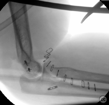 Subactue posterolateral elbow instability - LUCL internal brace ...