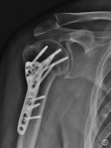 ORIF proximal humerus plate