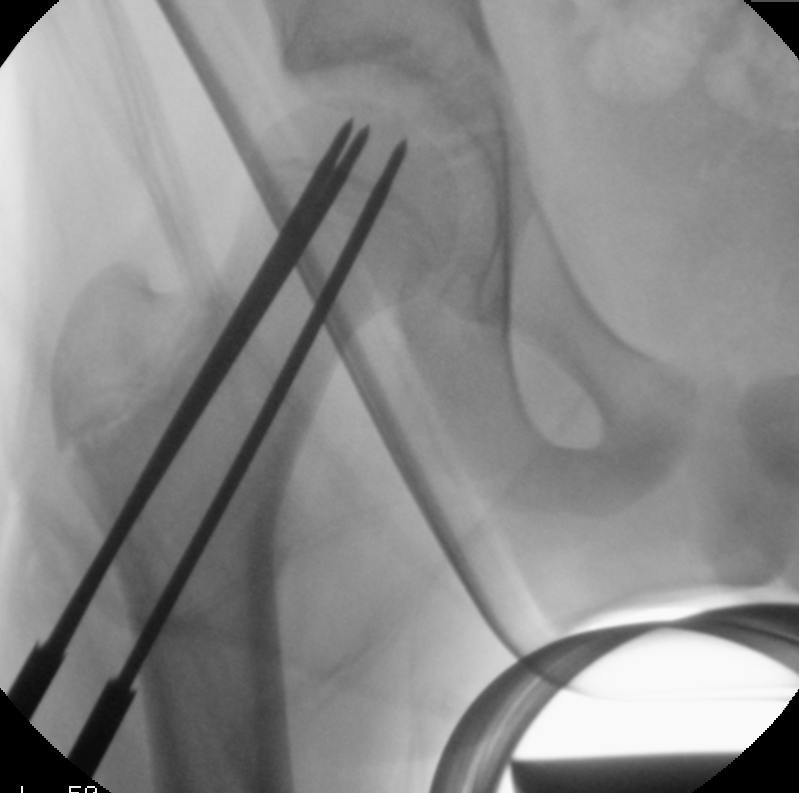 SCFE - Grade I - closed reduction and MIS osteosynthesis