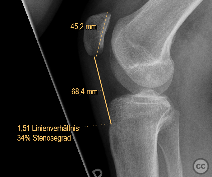 Destructive osteochondral fracture of the lateral femoral condyle ...