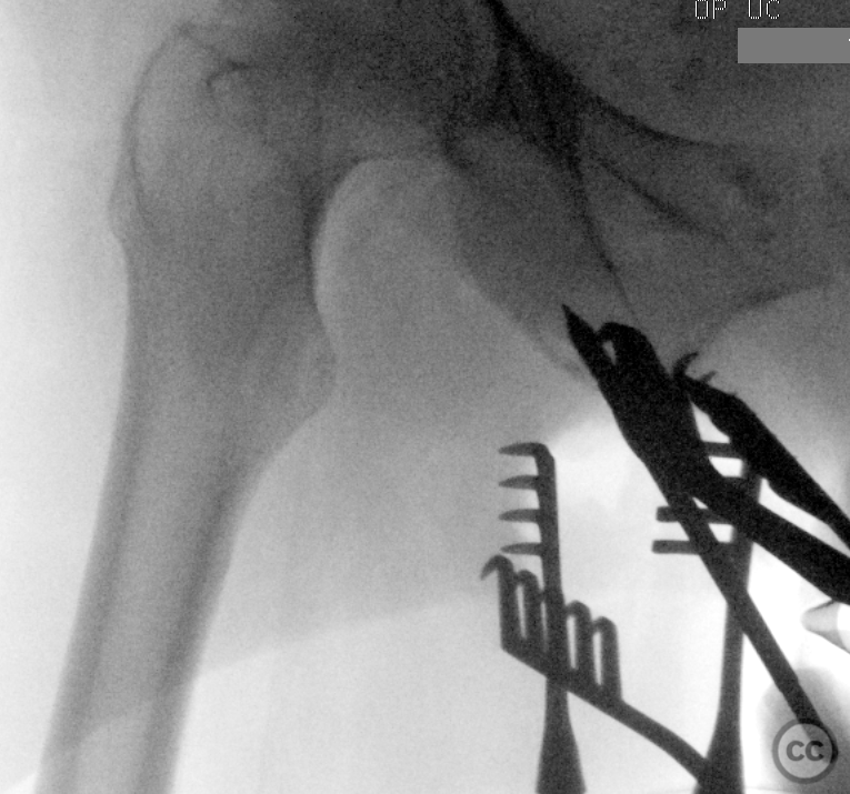 Proximal hamstring tendon avulsion