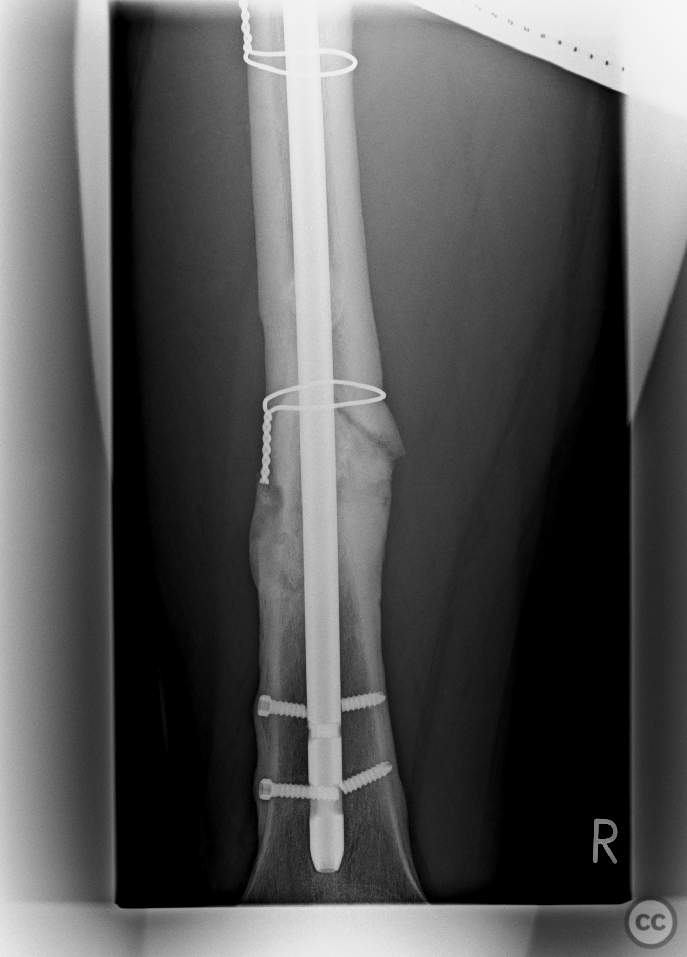 Closed segmental comminuted femoral fracture