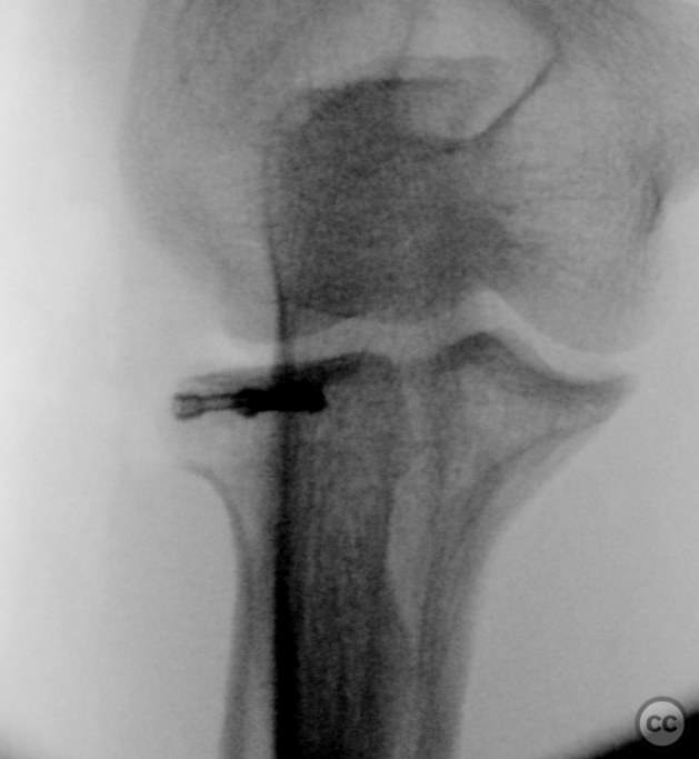 Mason II Radial Head Fracture