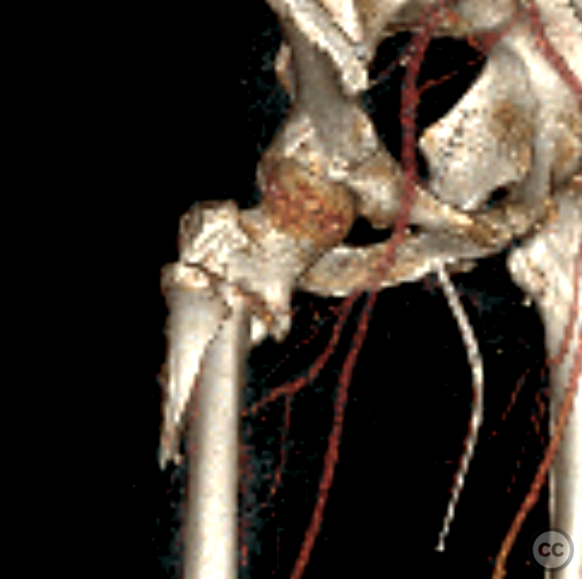 Hardware Failure of Primary Gamma Nail Osteosynthesis in ...